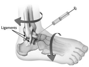 Ankle Injections in NYC - Sports Injury Clinic