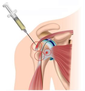 Shoulder Joint Injections in NYC - Sports Injury Clinic